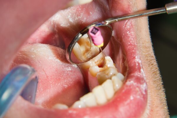 Can You Save Your Tooth Without a Root Canal? - Vanguard Dental Group